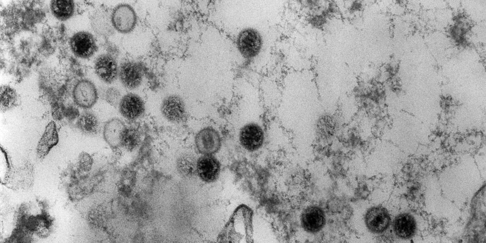 Scientists debate the role of a virus in multiple sclerosis